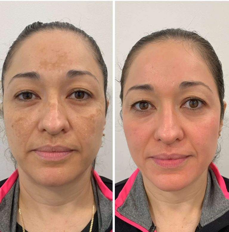 Tratamiento Despigmentante para manchas en la piel – Merlos & Caraza