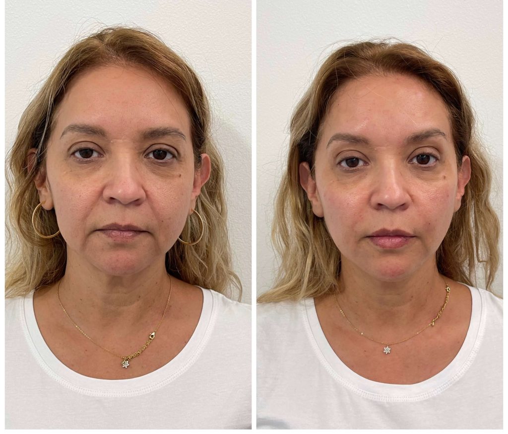 Relleno surco nasogeneano – Merlos & Caraza